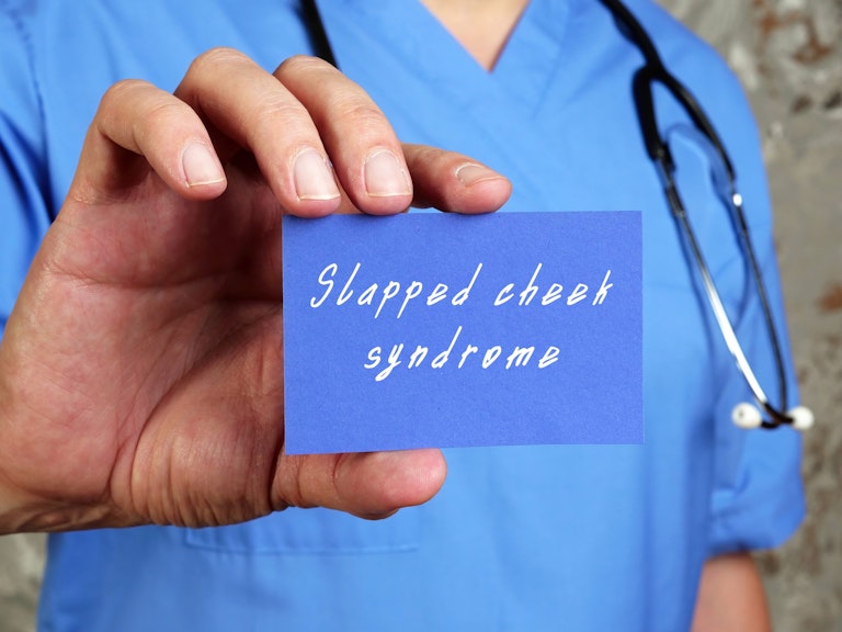 Slapped cheek syndrome: Symptoms & how to treat it