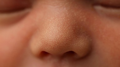 Baby milk spots (milia): Causes and how to get rid of them