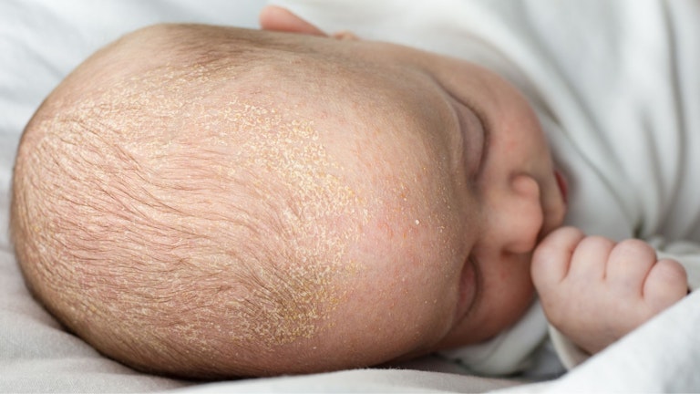 Cradle cap: what causes it and how is it treated?