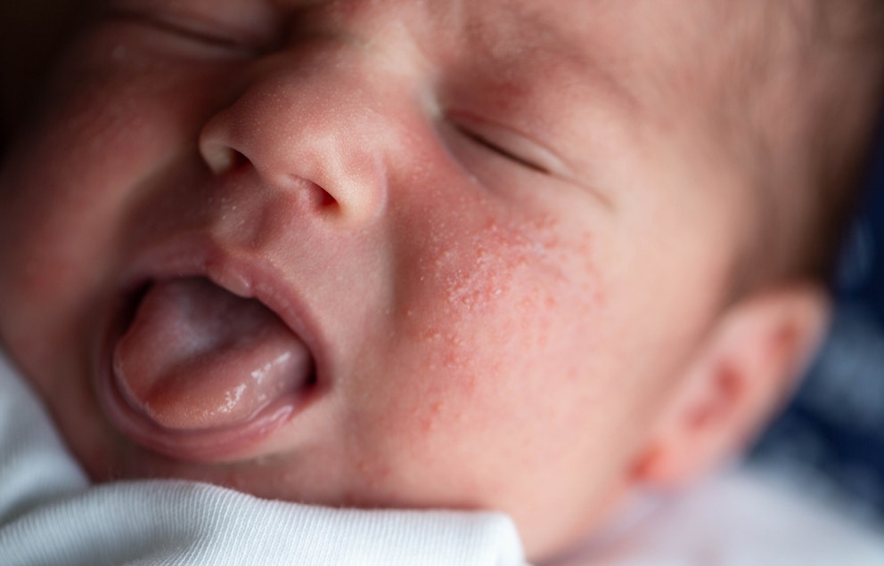 How to treat heat rash in babies and toddlers
