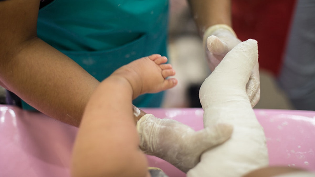 Clubfoot in babies | Cause, symptoms and treatments