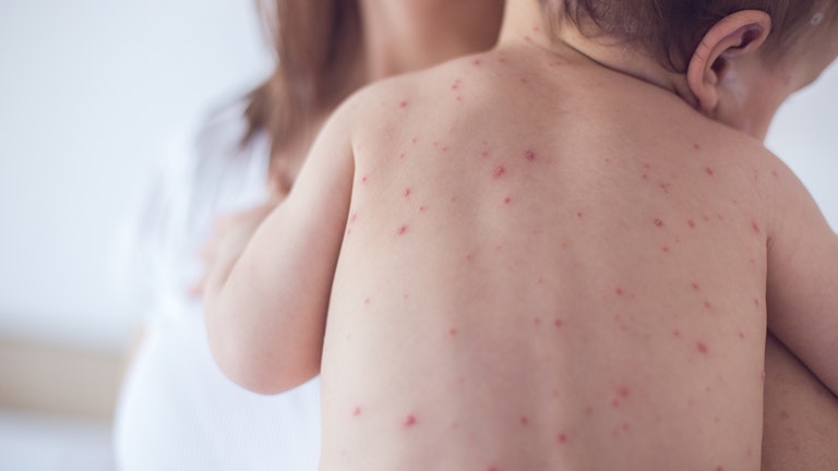 Understanding Baby Rashes: Identifying and Finding Causes