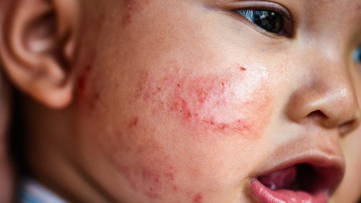Understanding Baby Rashes: Identifying and Finding Causes