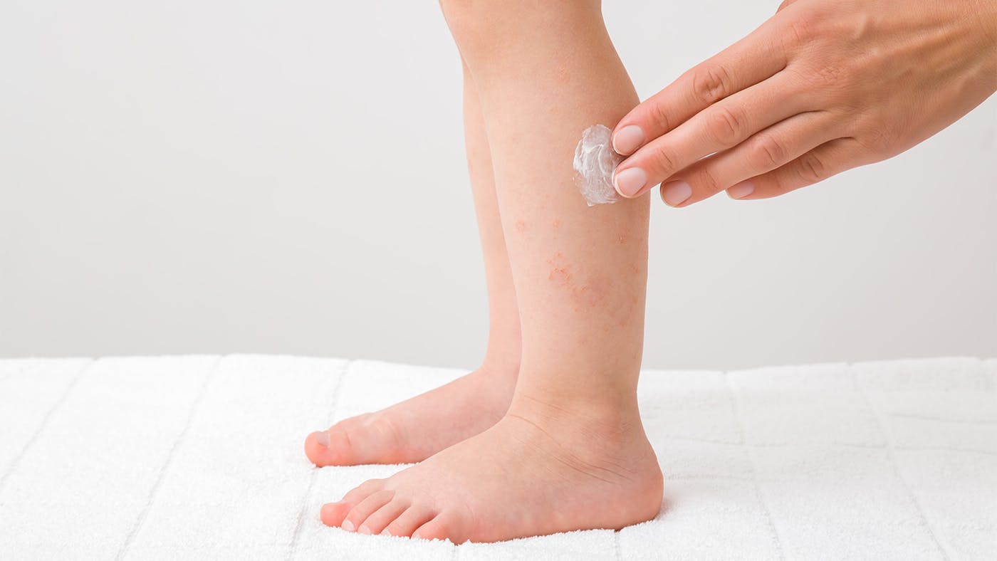 Baby hives: Everything you need to know