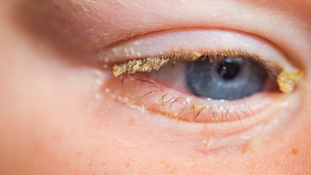 Conjunctivitis in babies: symptoms and treatment