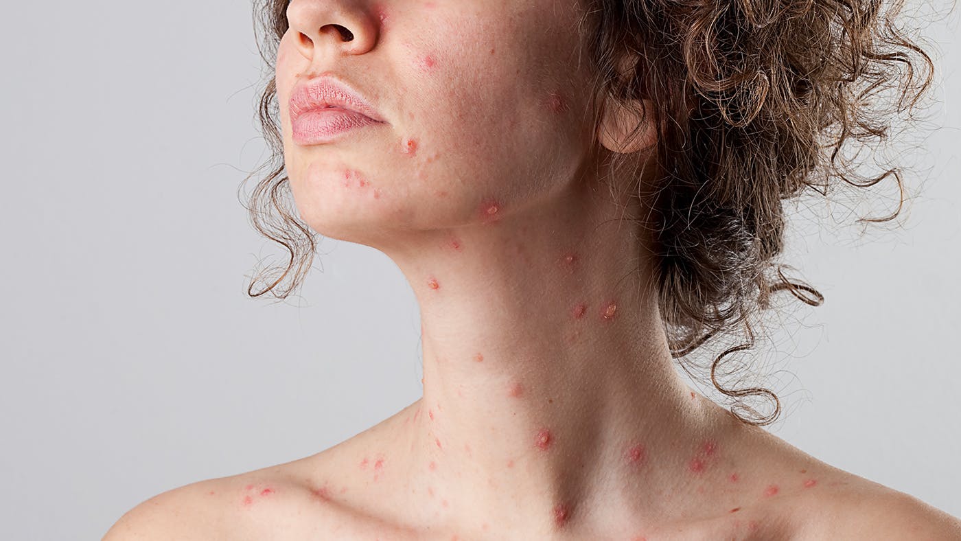 Your guide to chickenpox in pregnancy and how to treat it