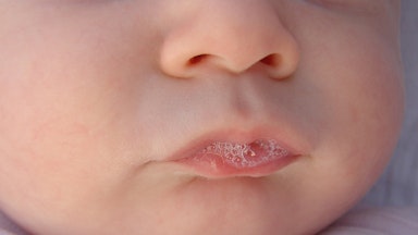 Teething rash treatment and prevention