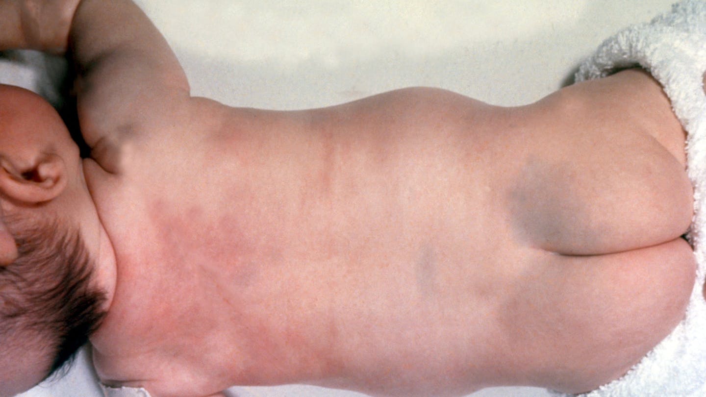 Blue grey Birthmarks Congenital Dermal Melanocytosis Blue grey Birthmarks Congenital Dermal Melanocytosis