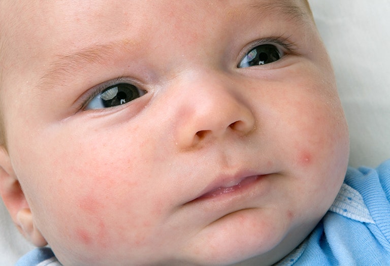 Baby skin trouble? How to spot common baby skin conditions