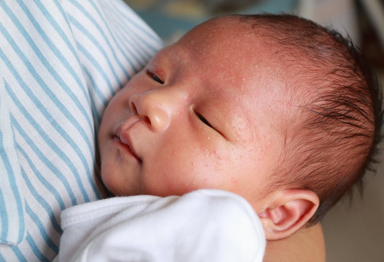 Baby Milk Spots Everything You Need To Know About Milia Baby baby-milk-spots-everything-you-need-to-know-about-milia-baby