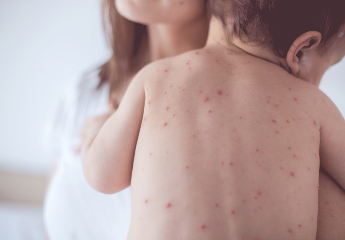Chicken Pox: Symptoms, Causes, and Treatment Guide