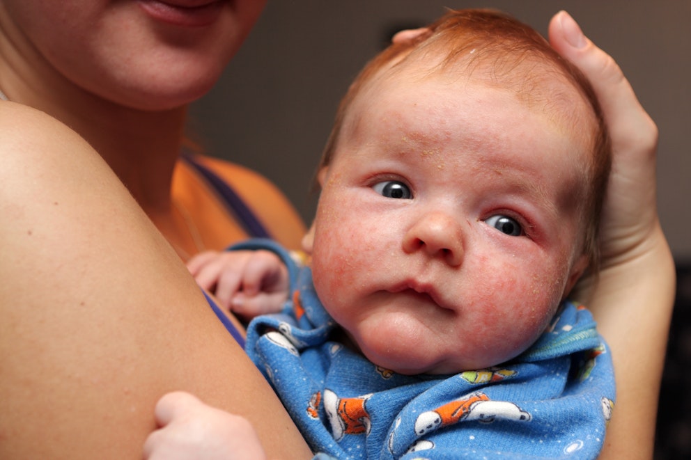 Baby Acne: Causes, symptoms and treatments