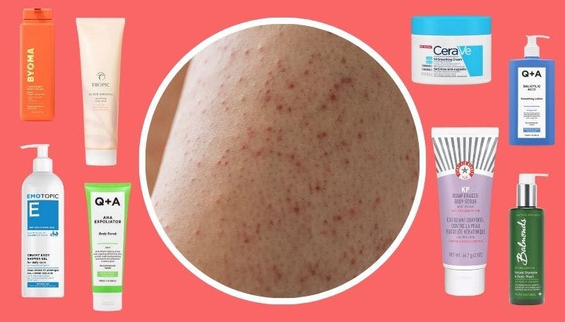 Best keratosis pilaris treatment I’ve tried UK 2024