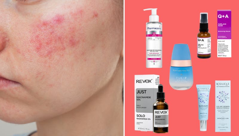 The best rosacea treatments to buy in the UK