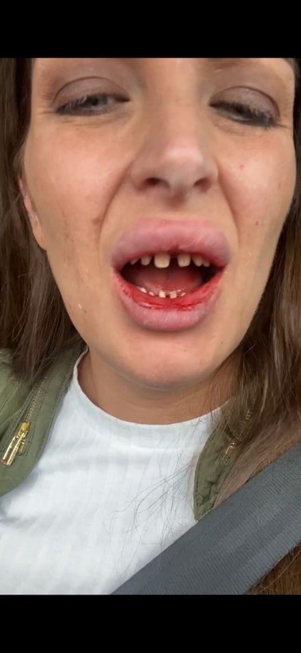 Turkey teeth horror: ‘My botched dental work left me suicidal’ | Closer