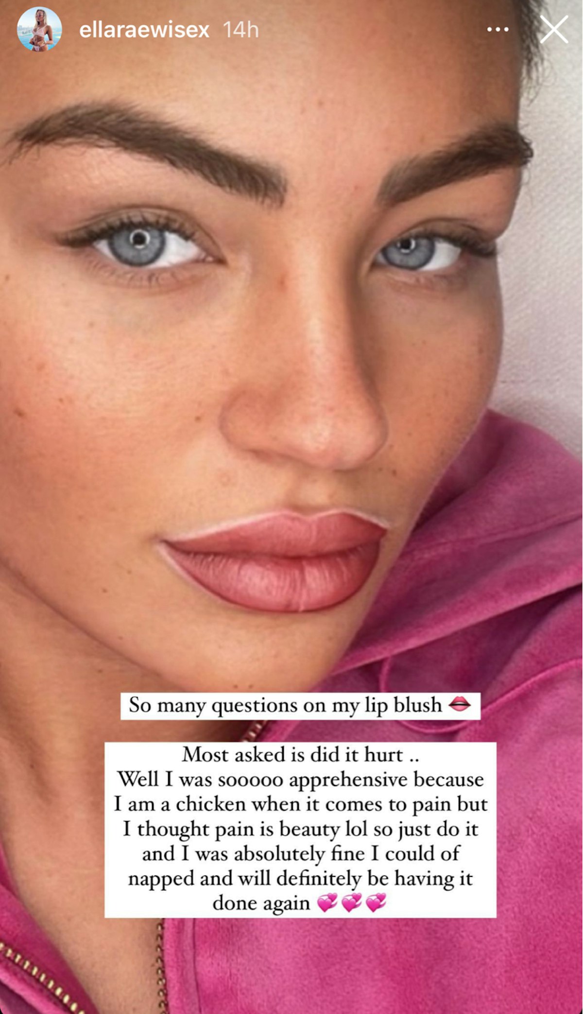 TOWIE’s Ella Rae Wise shows off ‘unreal’ lip transformation ahead of ...