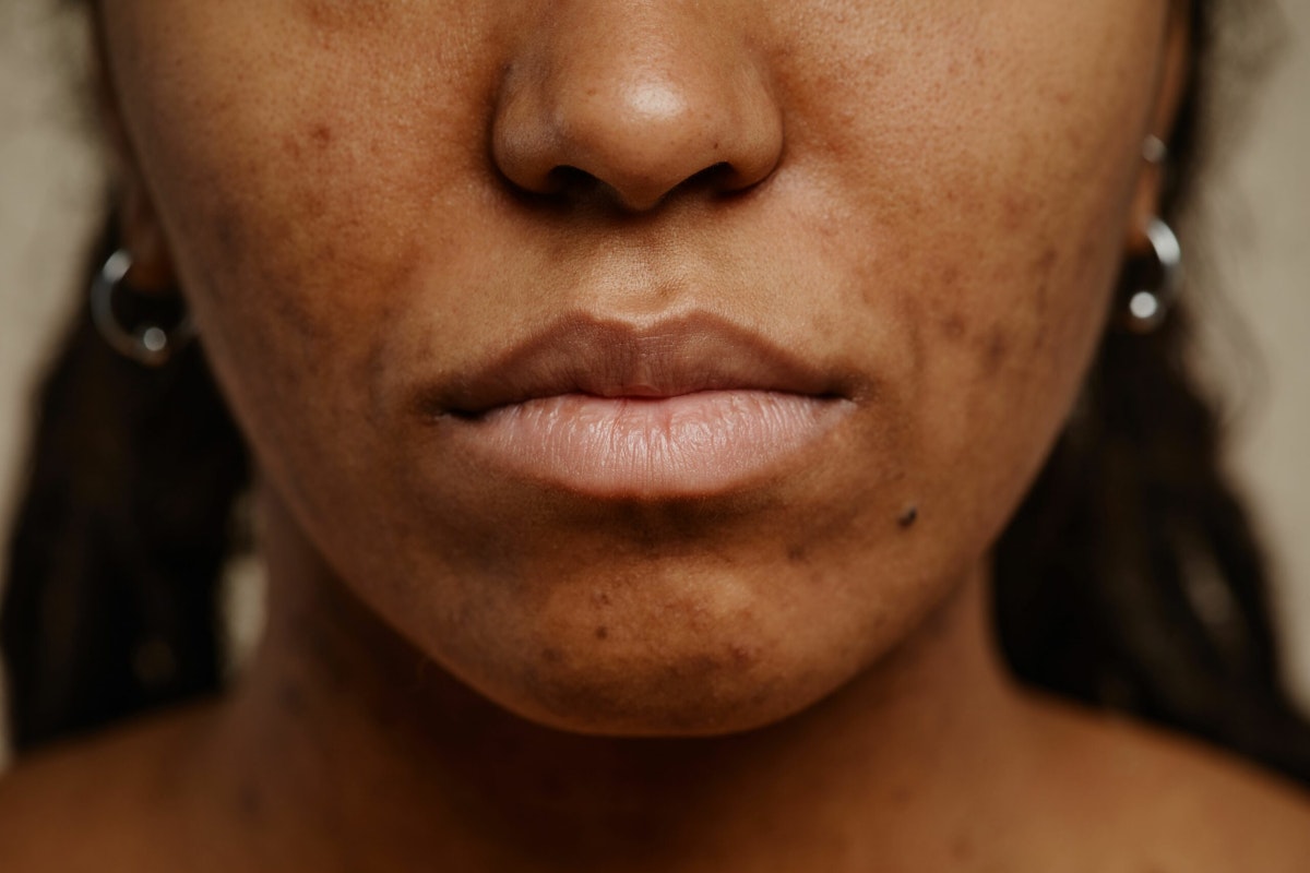How to get rid of textured skin, according to industry experts