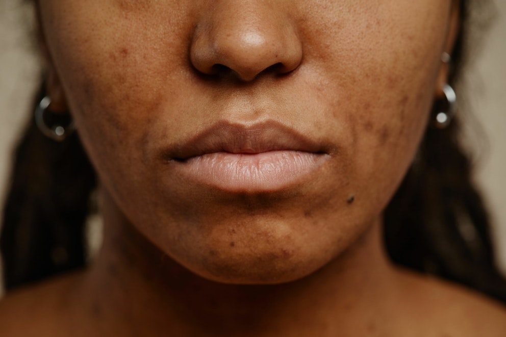 How to get rid of textured skin, according to industry experts