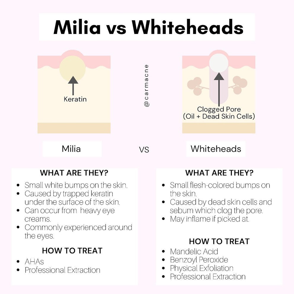 How to get rid of whiteheads: the dermatologist approved advice you ...