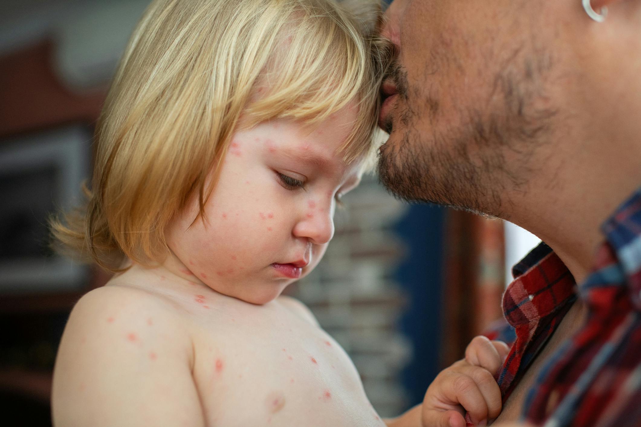Can I Go To Work If My Child Has Chickenpox?