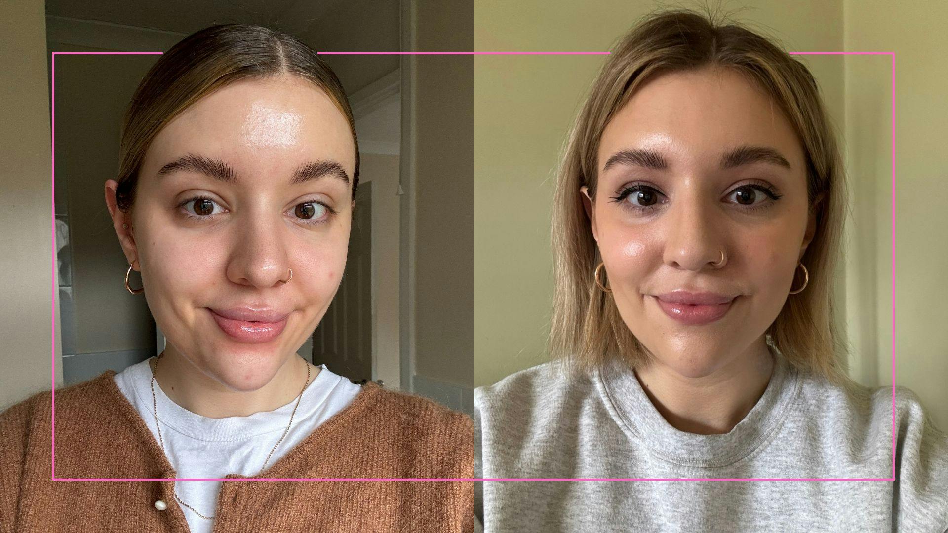 What Is 'Microtox' And Will It Replace Botox? Here's Everything You Need To Know