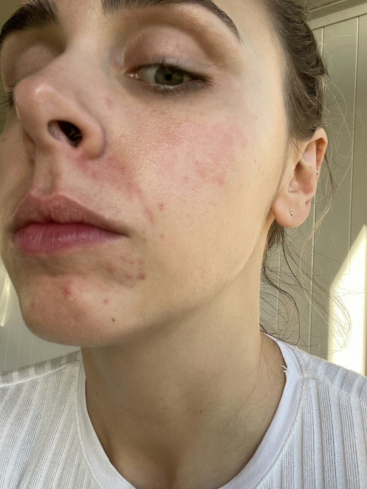 What Is Perioral Dermatitis And How Can You Treat It?