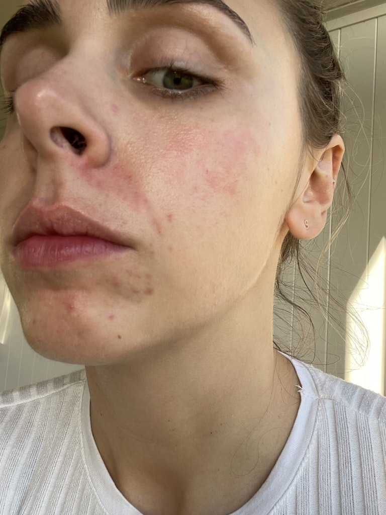 What Is Perioral Dermatitis And How Can You Treat It?