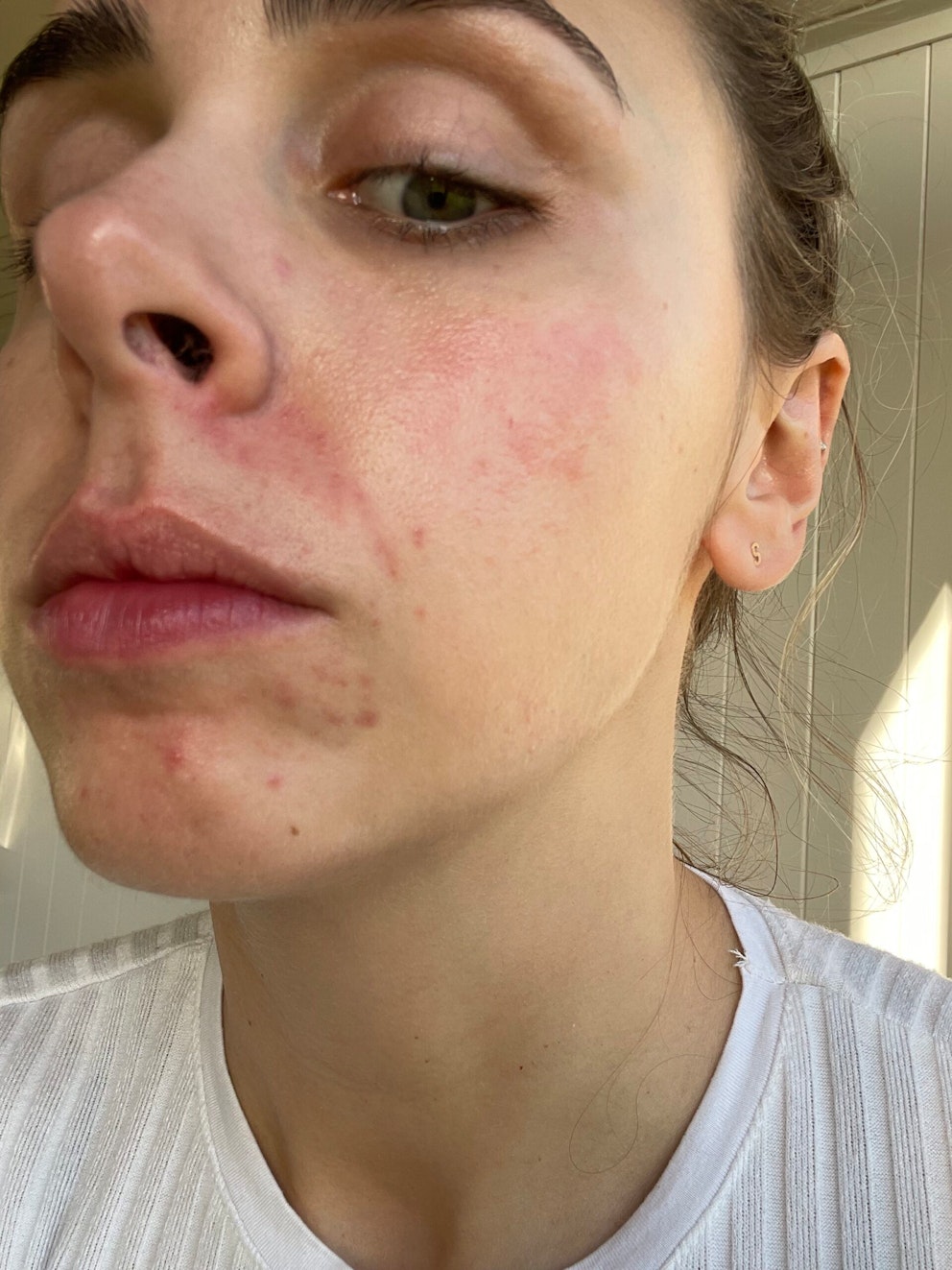 What Is Perioral Dermatitis And How Can You Treat It?