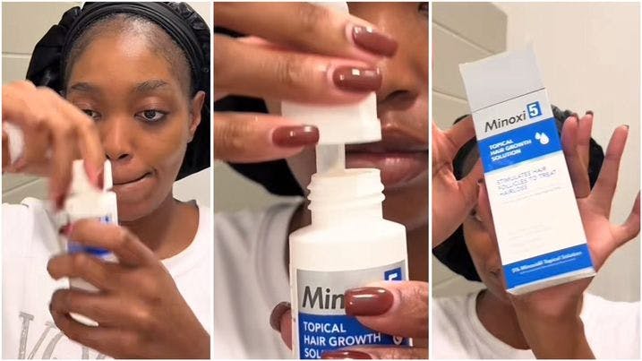What Is Minoxidil? And Why Is The Internet Using It To Grow Their Hair?
