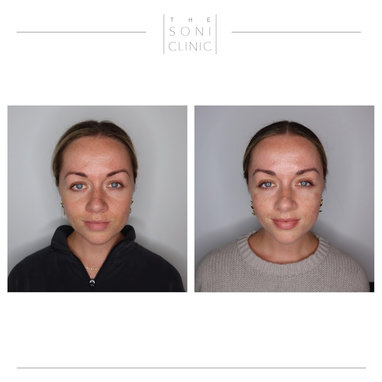 Our Review Of The Viral Polynucleotide Treatment