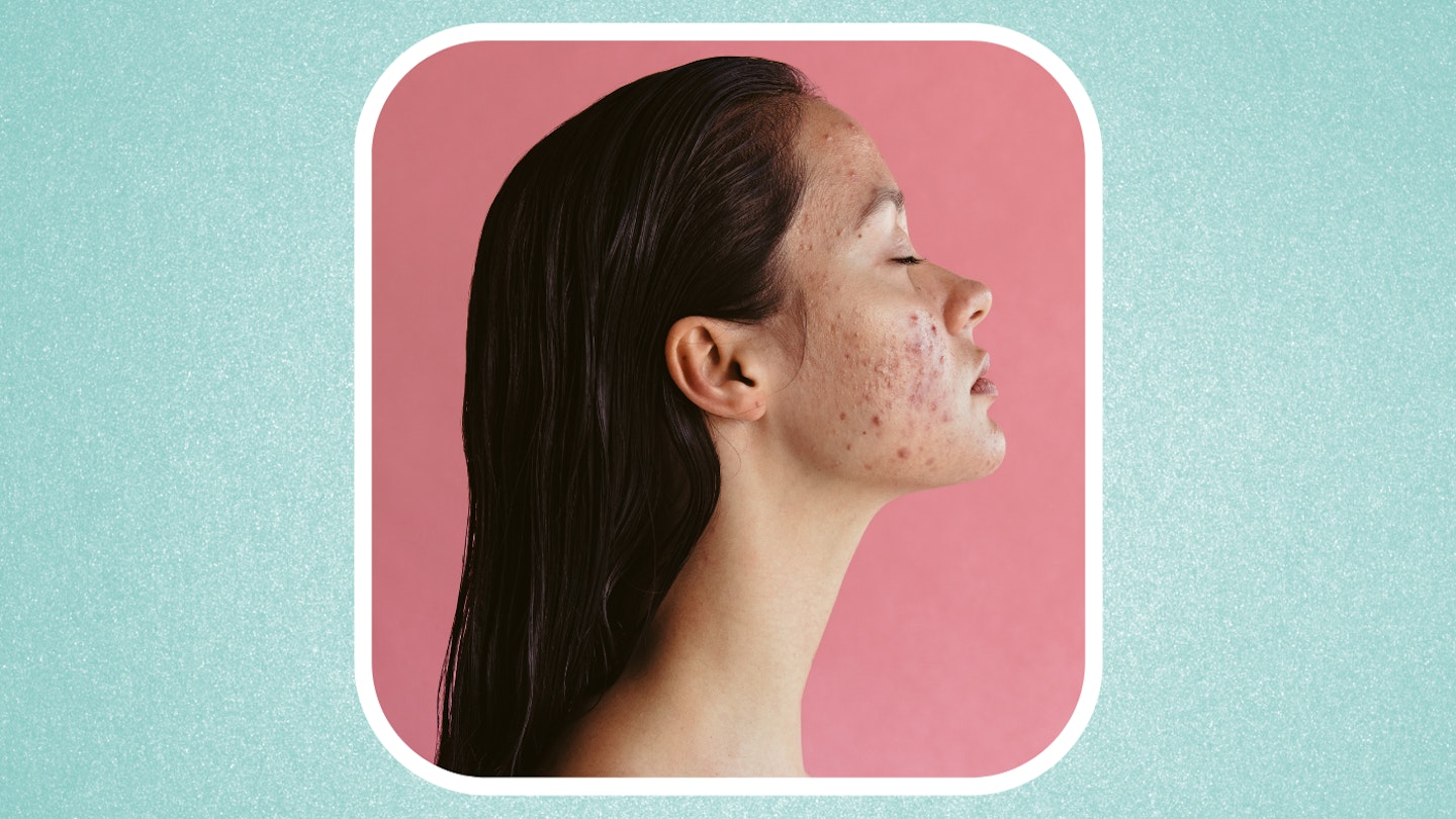 Treat Hormonal Acne The Five Products That Worked