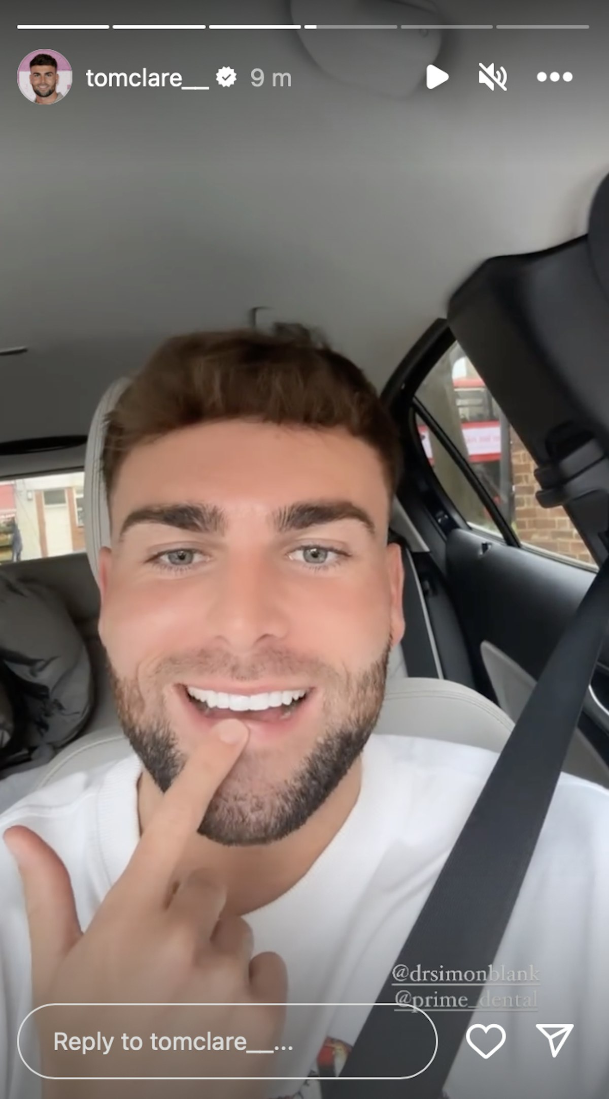 Love Island's Tom Clare unveils teeth transformation and WOW