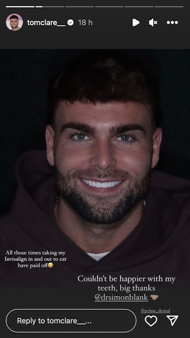 Love Island's Tom Clare unveils teeth transformation and WOW