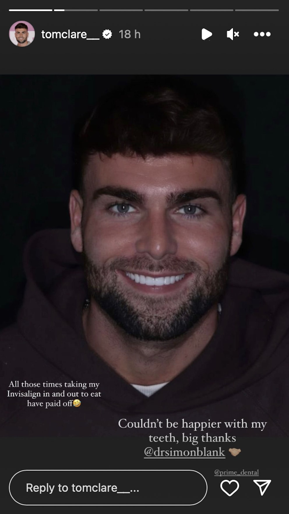 Love Island's Tom Clare unveils teeth transformation and WOW