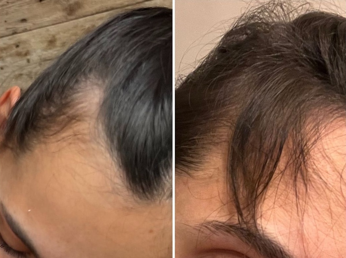 Champo Pitta Hair Growth Serum review - my honest results