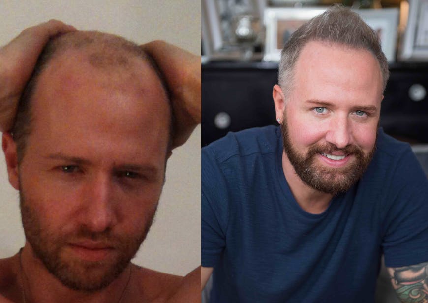 Gogglebox's Chris Steed had secret £10,000 hair transplant - Closer