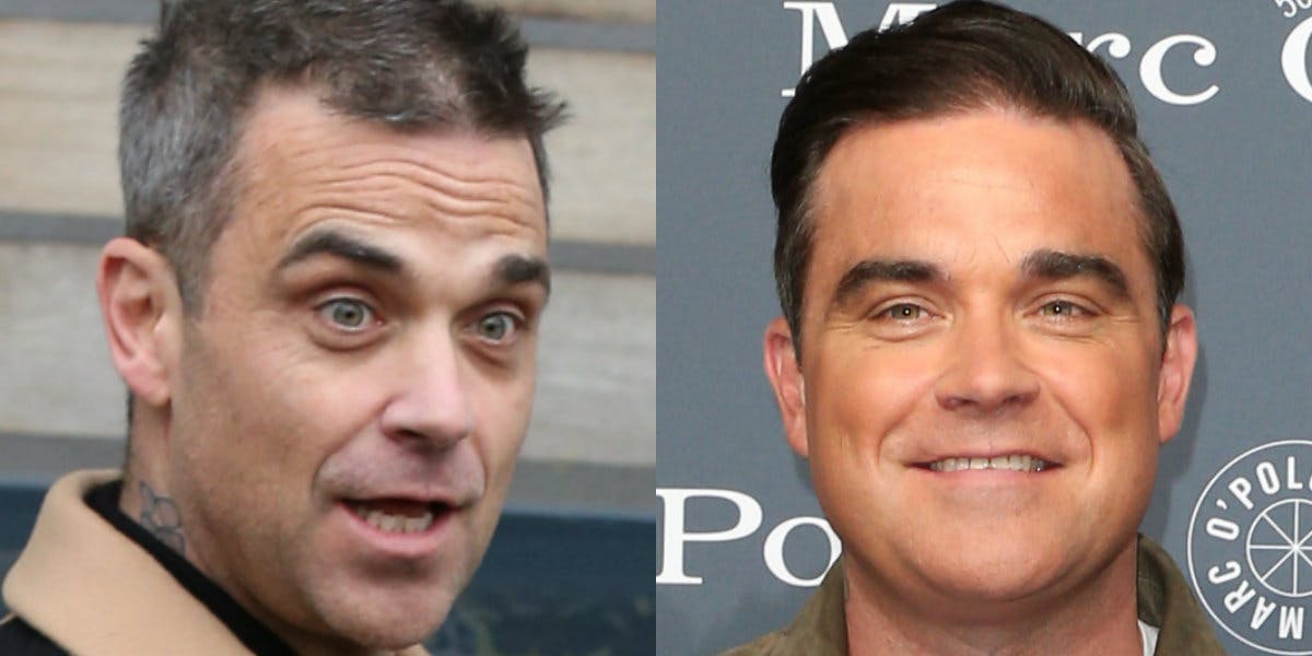 There’s something different about Robbie Williams’ face… | Closer