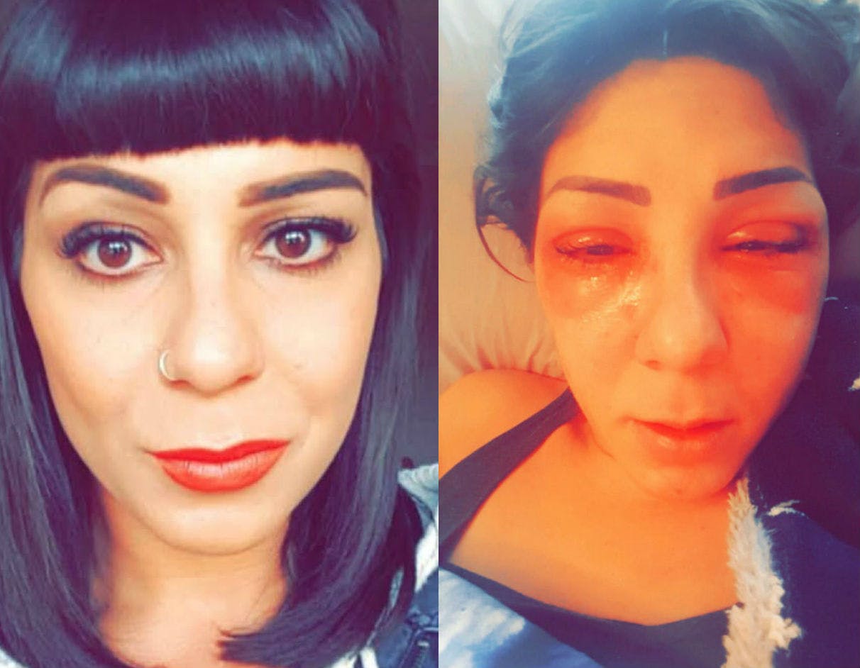 Layla Kilany suffered a horrible allergic reaction from an eyelash lift ...