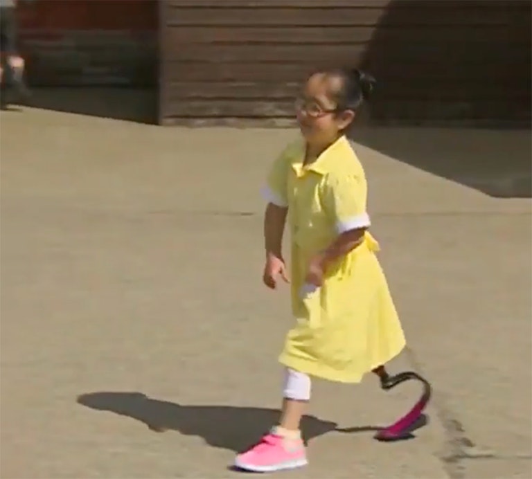 7-year-old girl shows friends new prosthetic leg for first time and ...