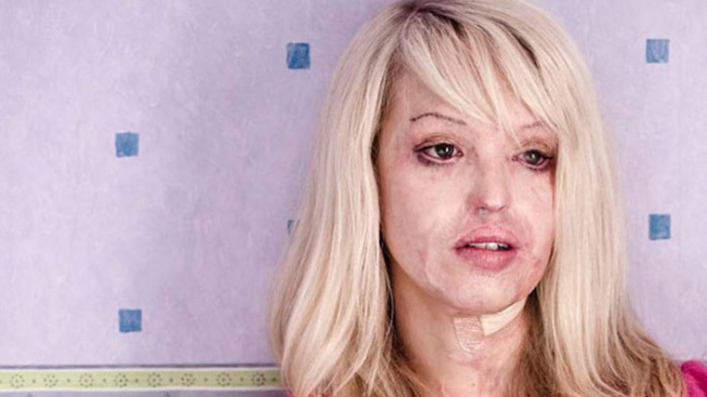 Katie Piper has shared an image taken just after her acid attack ...