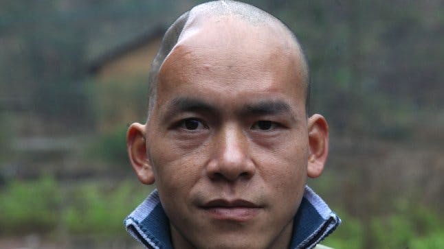 Man has lived for three years with a third of his skull missing | Closer