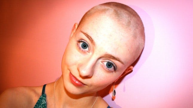 Girl with compulsive hair-pulling disorder chronicles her experience in ...