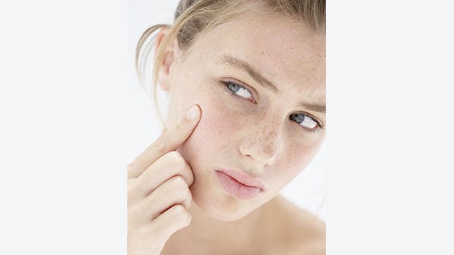 Adult acne: causes and treatment | Closer