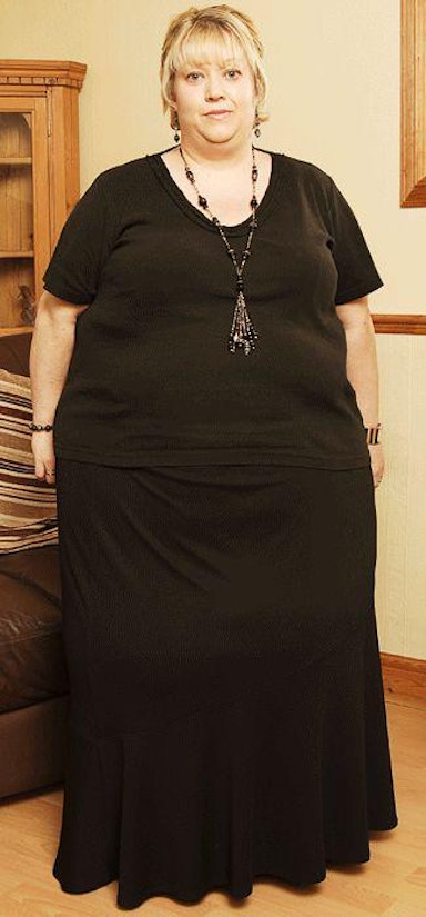 Real life apronectomy ‘my 2 ft tummy hangs below my knees’ | Closer