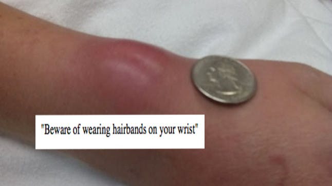 Woman’s warning after hairband leaves her with horrific abscess | Closer