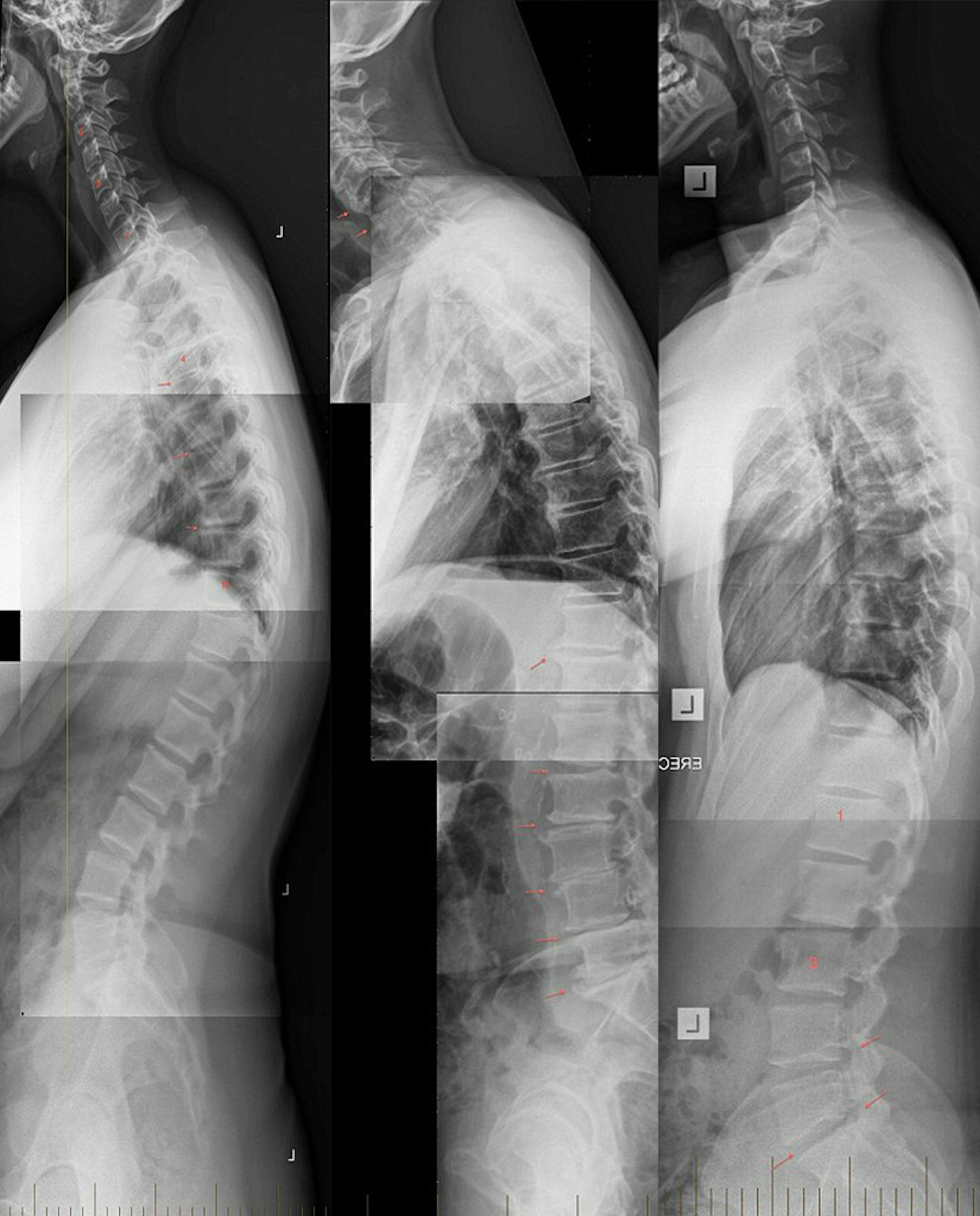 Scary X-Ray Pictures Show What Your Phone Is Doing To Your Spine