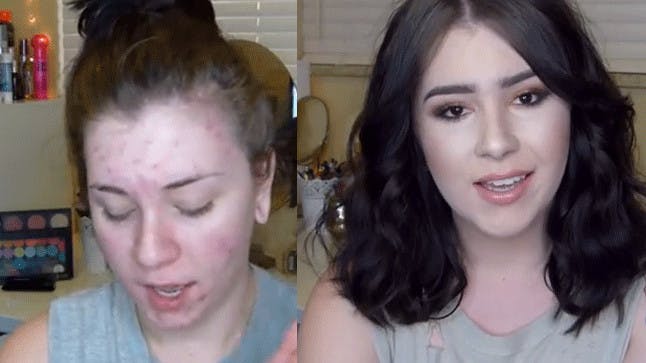 How to cover acne with make up | Closer