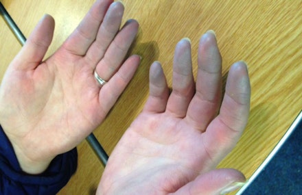 Cold or numb fingers? Spot the signs of the condition more common than ...