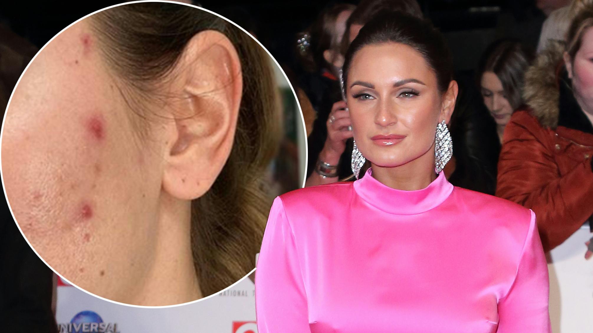 Sam Faiers reveals secret battle with adult acne in make-up free photos