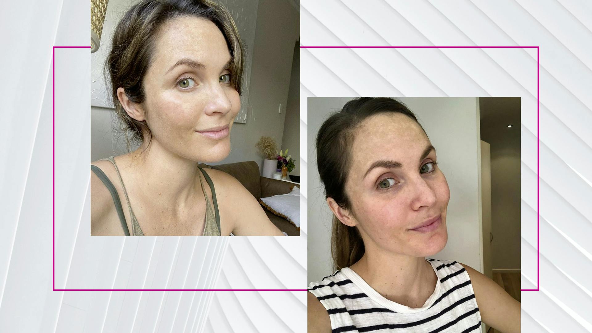 Pregnancy Pigmentation Explained | Grazia